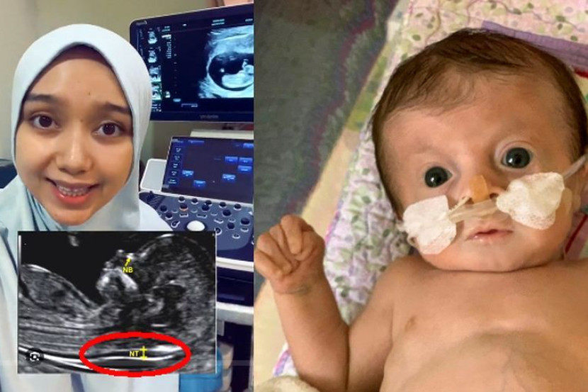 Risau anak hidap sindrom unik? Ibu hamil boleh buat imbasan ini ketika usia kandungan 11 hingga ...